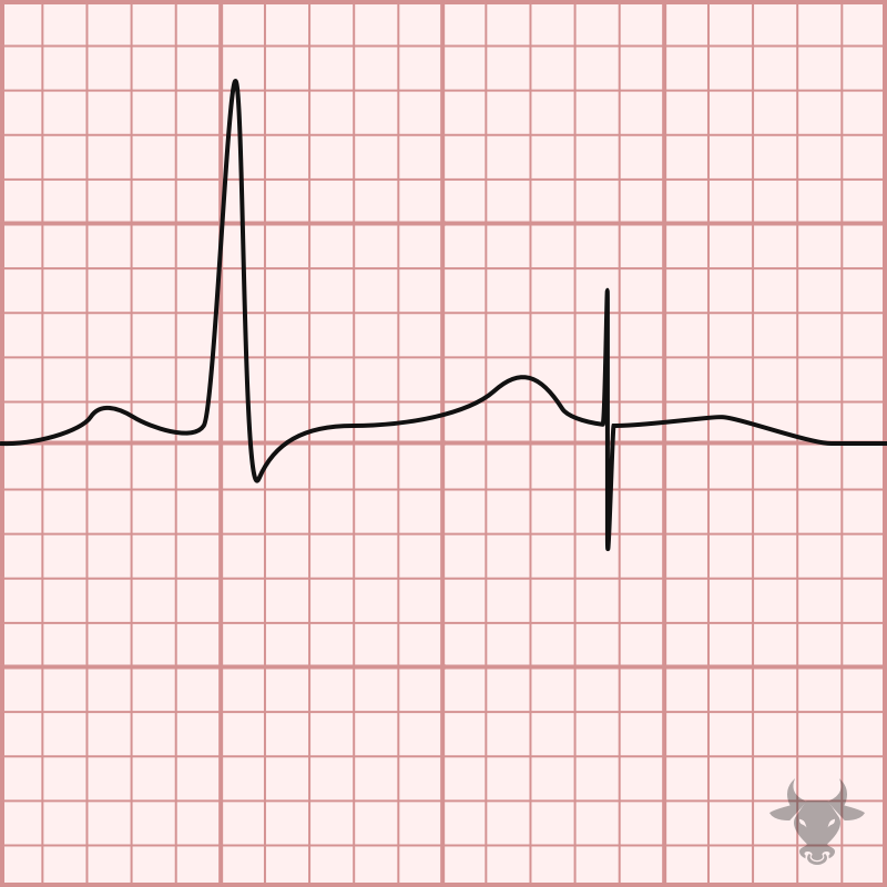 Pacemaker Malfunction ECG Stampede Pacemaker Malfunction ECG Stampede