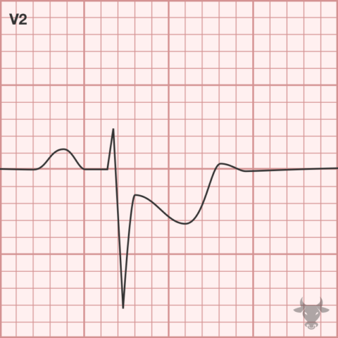 Posterior Myocardial Infarction | ECG Stampede
