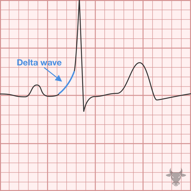 Ventricular Pre excitation ECG Stampede