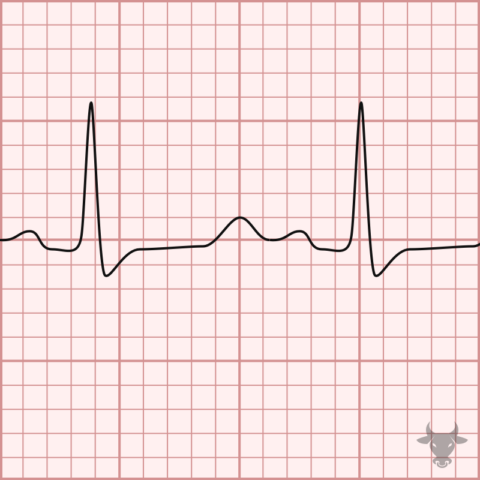 Prolonged QT | ECG Stampede