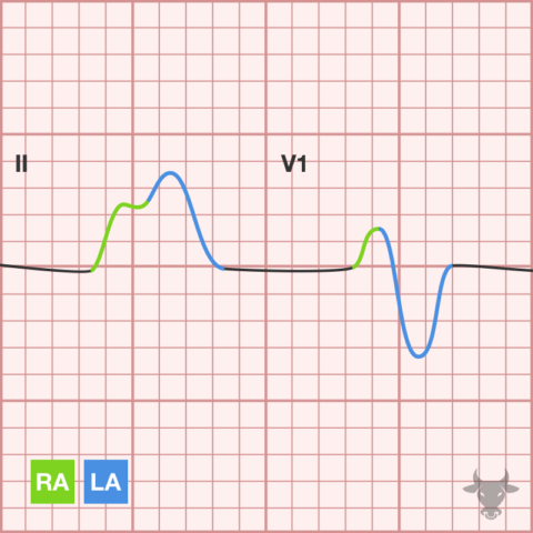 Right Atrial Enlargement | ECG Stampede
