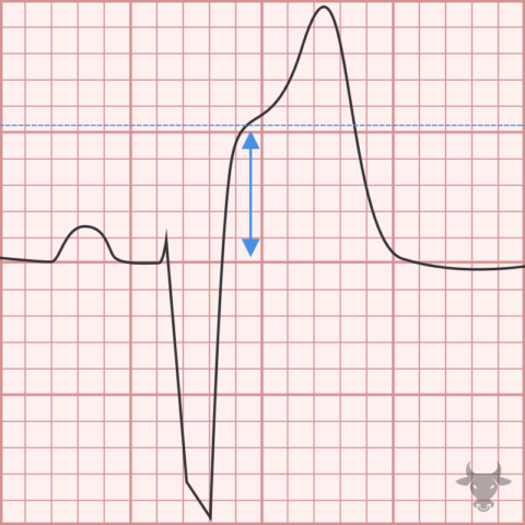 Sgarbossa Criteria | ECG Stampede