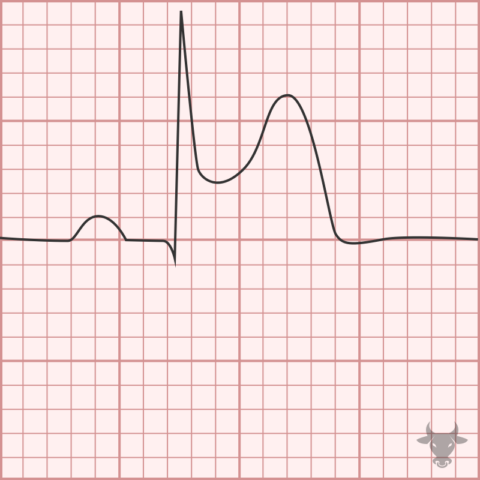ST-elevation Myocardial Infarction | ECG Stampede