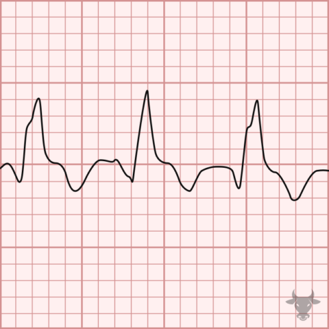 Supraventricular Tachycardia with Aberrancy | ECG Stampede