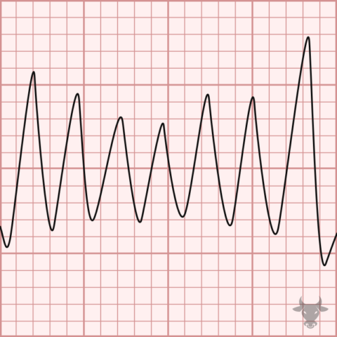 Torsade de Pointes | ECG Stampede