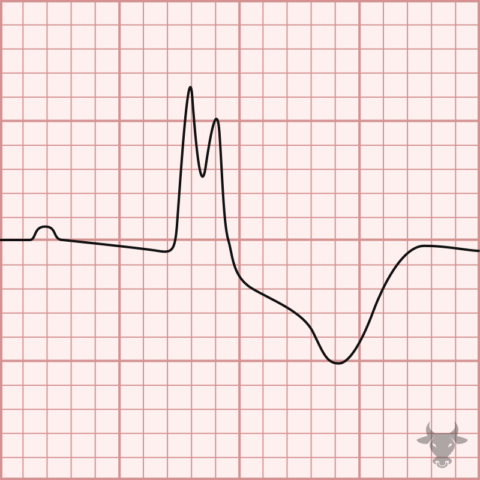 Trifascicular Block | ECG Stampede
