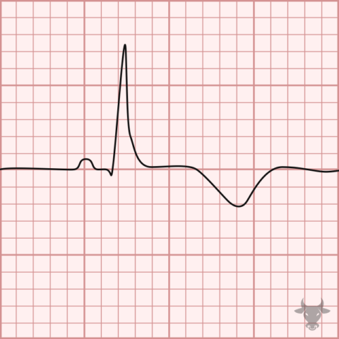 T-wave Inversions | ECG Stampede