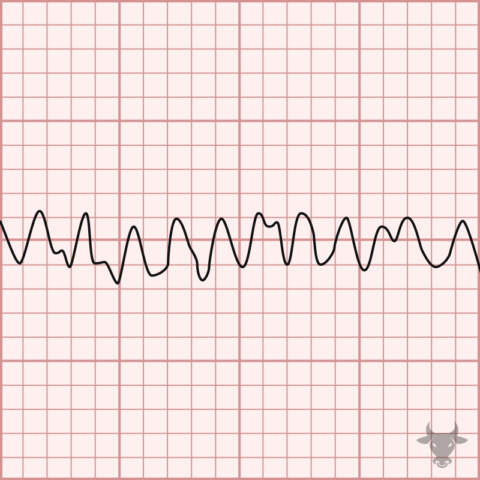Ventricular Fibrillation | ECG Stampede