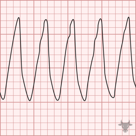 Ventricular Tachycardia | ECG Stampede