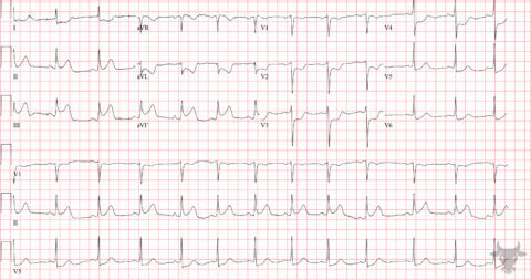 ST-elevation Myocardial Infarction | ECG Stampede