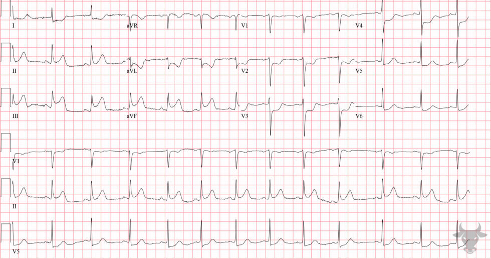 ST-elevation Myocardial Infarction | ECG Stampede