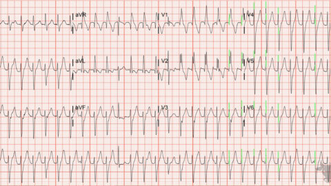 Ventricular Tachycardia | ECG Stampede