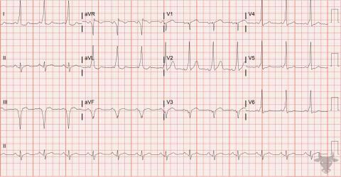 Ventricular Pre-excitation | ECG Stampede