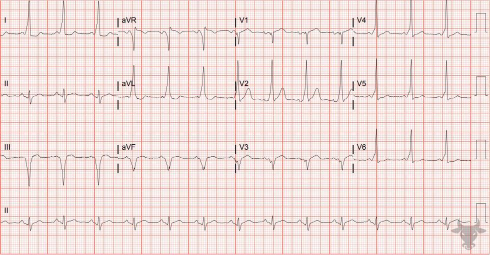 Ventricular Pre-excitation | ECG Stampede