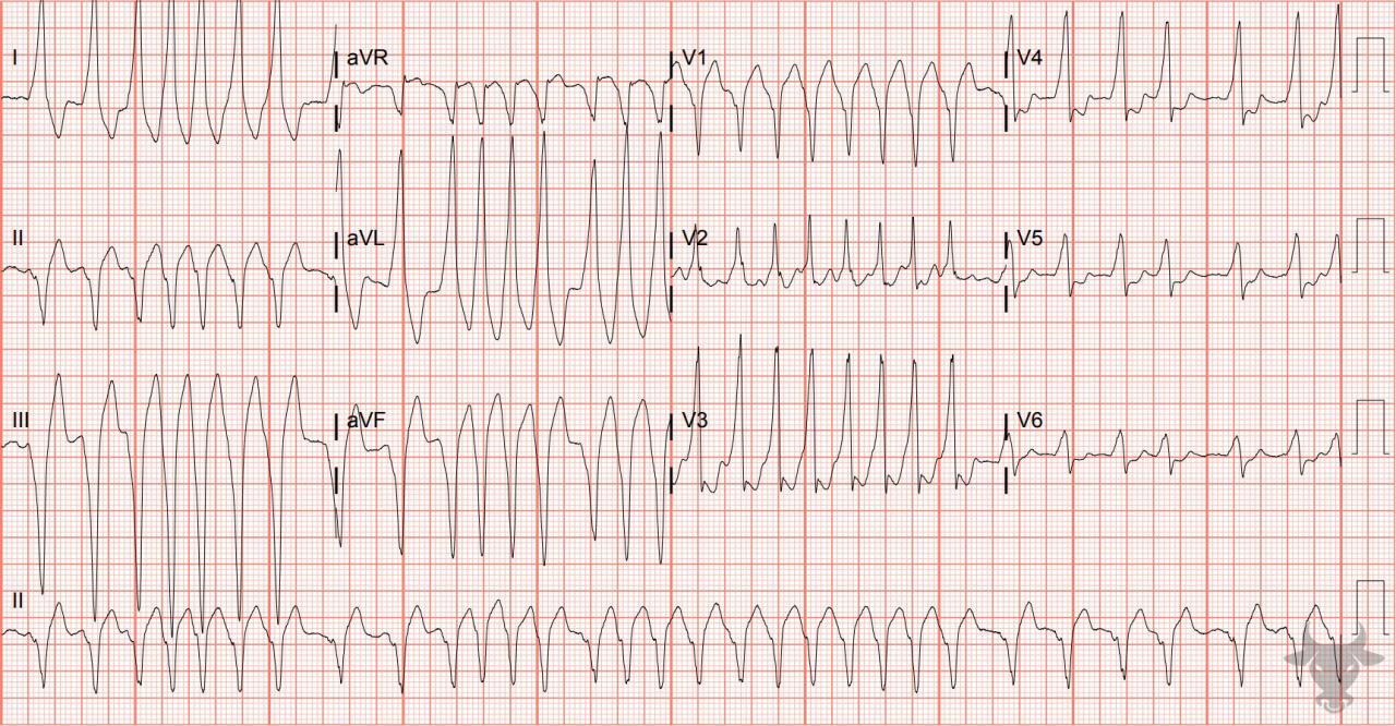 Ventricular Pre-excitation | ECG Stampede
