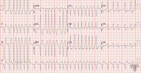 Ventricular Pre-excitation | ECG Stampede