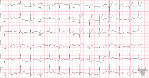 Hyperacute T Waves | ECG Stampede