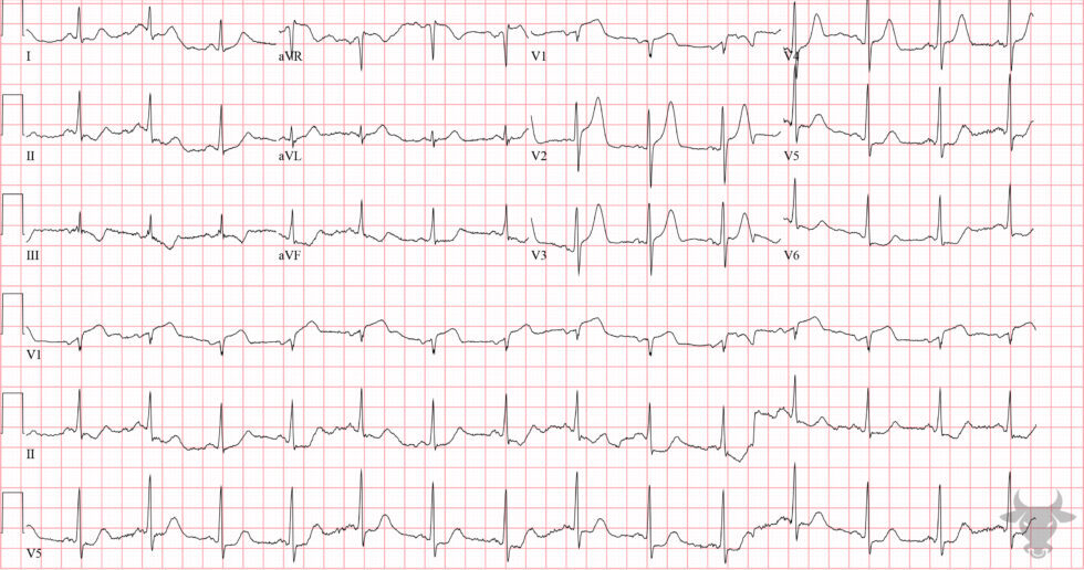 Hyperacute T Waves | ECG Stampede