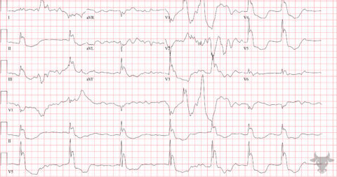 Hypothermia | ECG Stampede