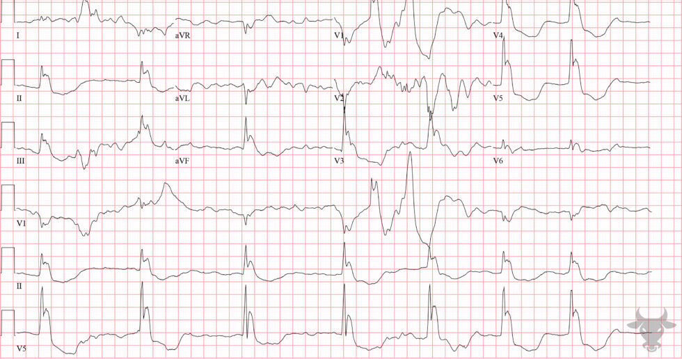 Atrial Fibrillation | ECG Stampede