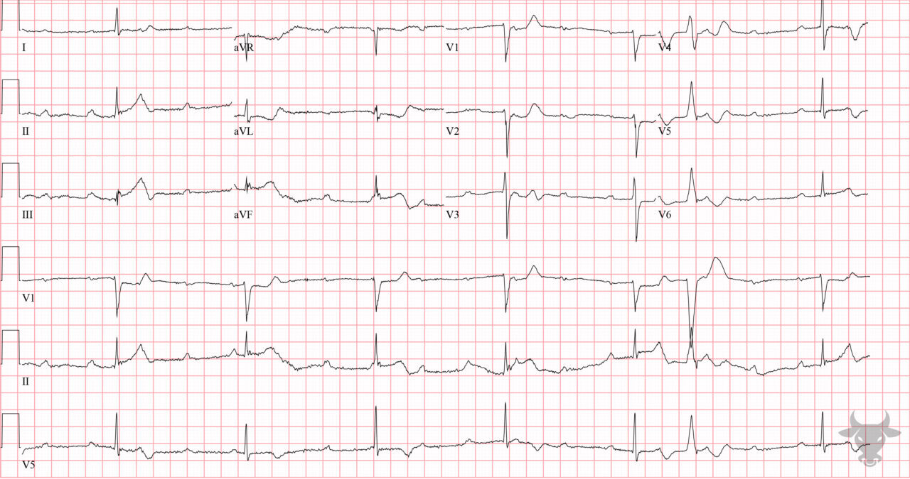 Third Degree Atrioventricular Block | ECG Stampede