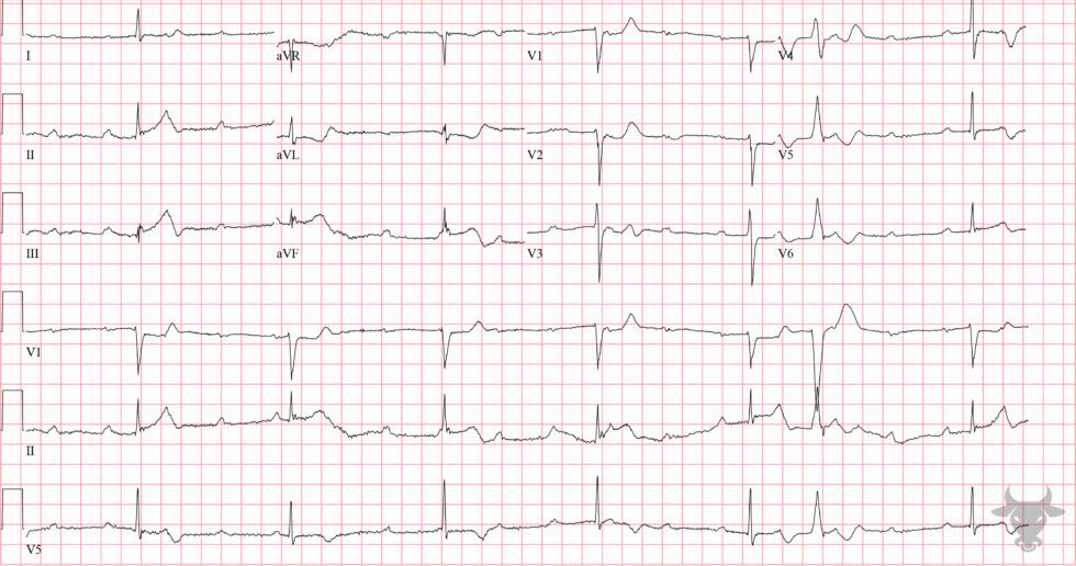 ST-elevation Myocardial Infarction | ECG Stampede
