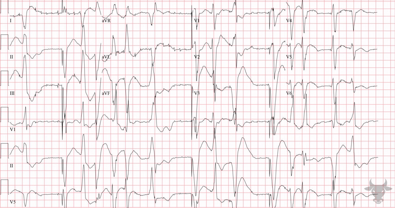 Hypokalemia | ECG Stampede