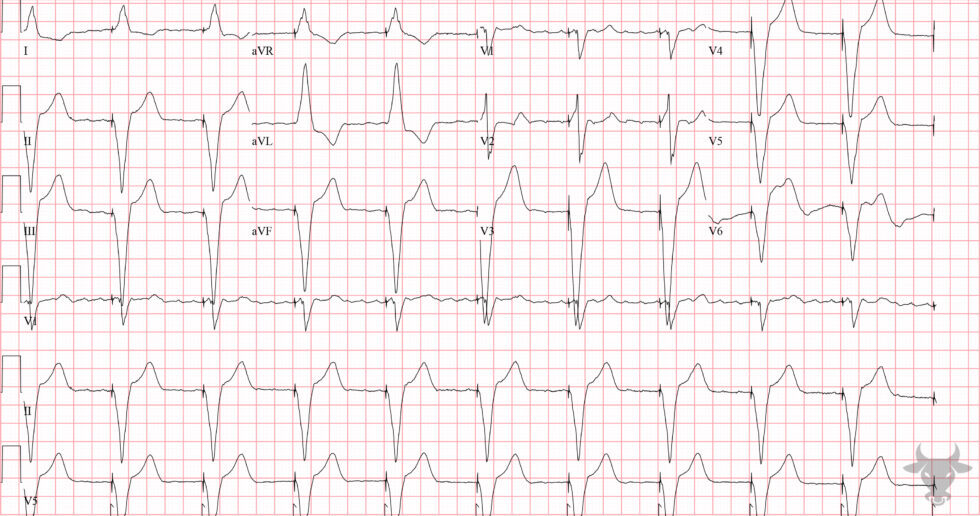 Paced Rhythms | ECG Stampede