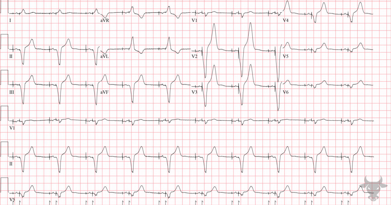 Paced Rhythms | ECG Stampede