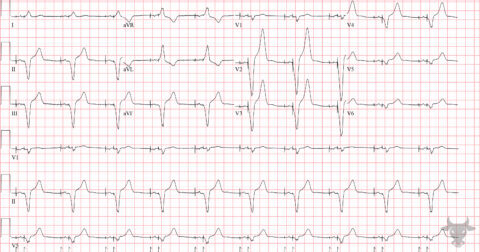 Paced Rhythms | ECG Stampede
