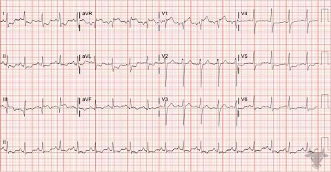 Aslanger Pattern | ECG Stampede