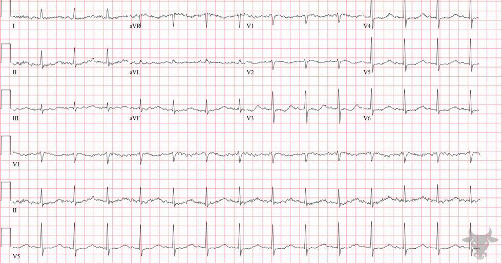 Hypokalemia | ECG Stampede