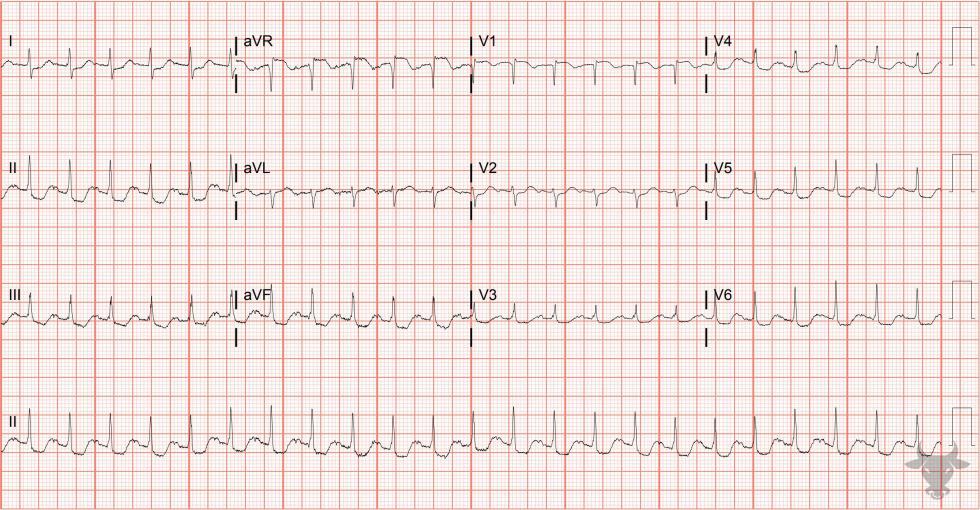Global Subendocardial Ischemia | ECG Stampede