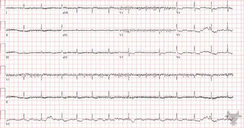Digoxin Toxicity | ECG Stampede