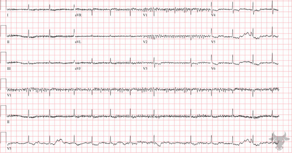 Digoxin Toxicity | ECG Stampede
