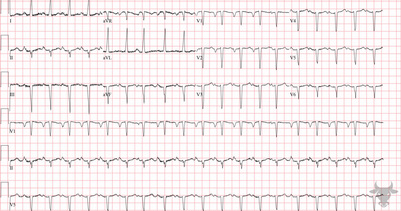Poor R-wave Progression | ECG Stampede