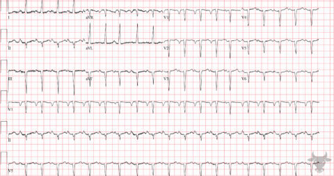 Poor R-wave Progression | ECG Stampede