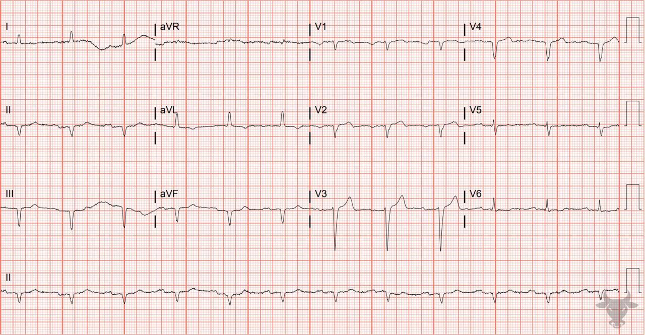 Poor R-wave Progression | ECG Stampede