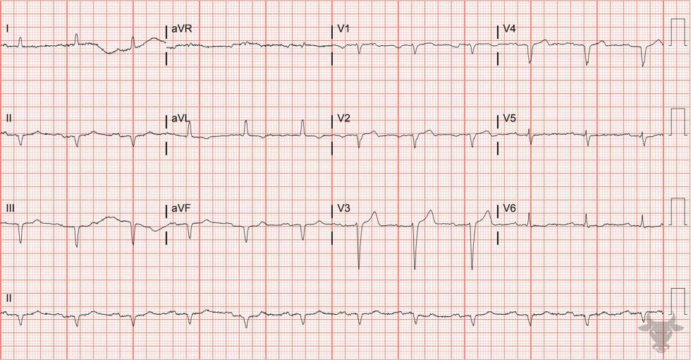 Poor R-wave Progression | ECG Stampede