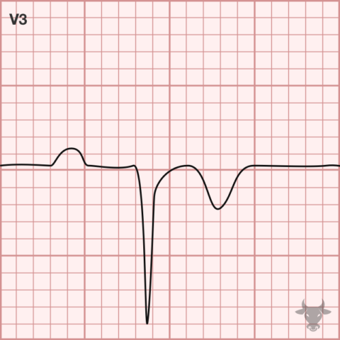 Poor R-wave Progression | ECG Stampede