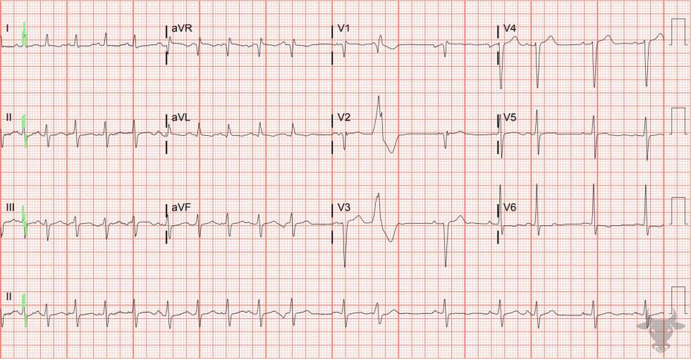 Multifocal Atrial Tachycardia | ECG Stampede