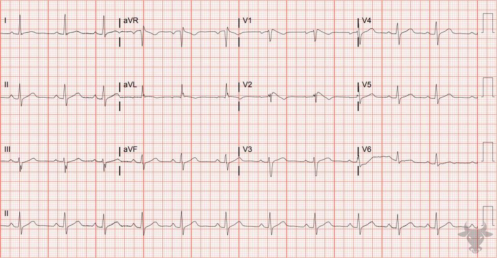 Brugada Syndrome | ECG Stampede