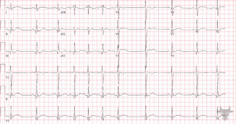 Prolonged QT | ECG Stampede