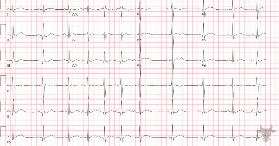 Prolonged QT | ECG Stampede