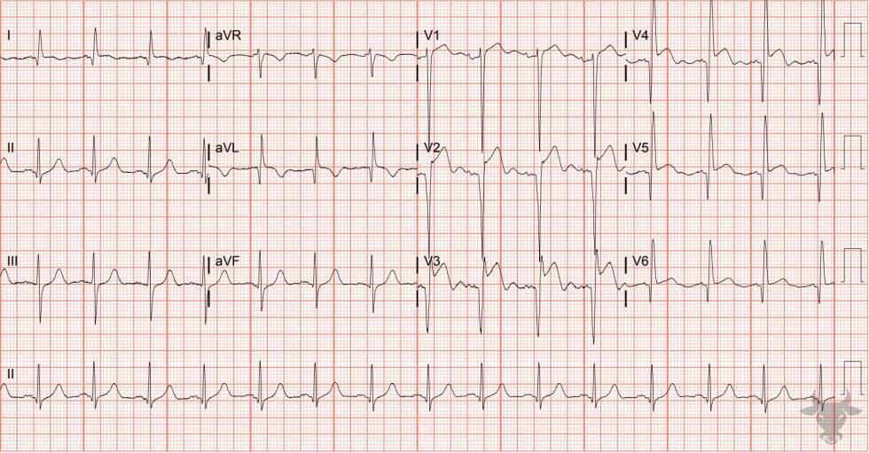 Left Ventricular Aneurysm | ECG Stampede