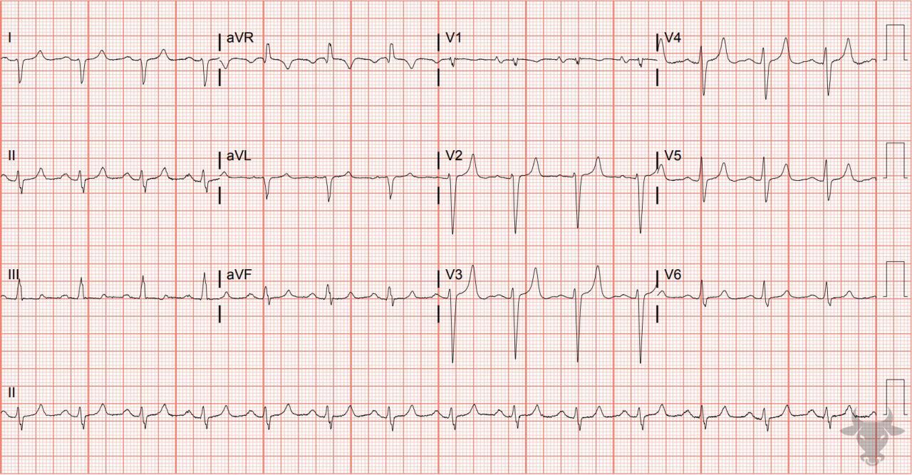 Hyperkalemia | ECG Stampede