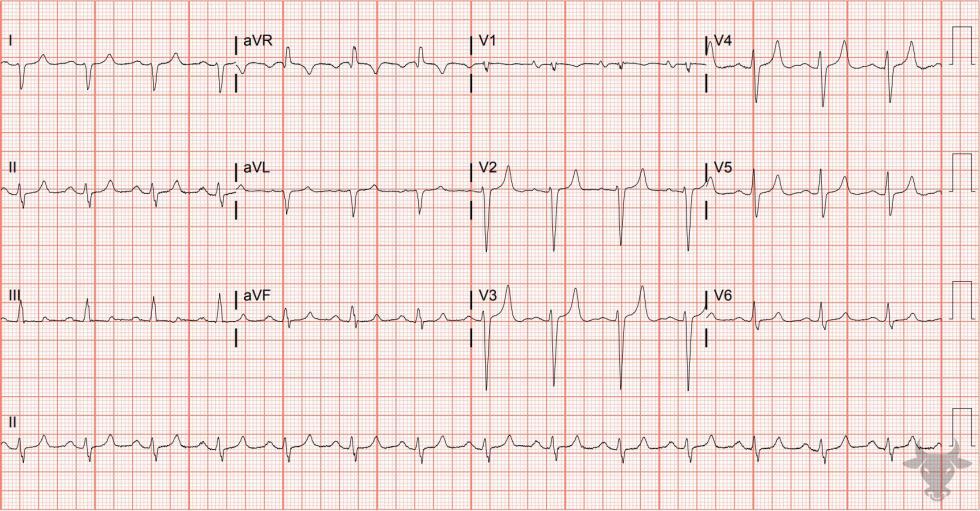 Hyperkalemia | ECG Stampede