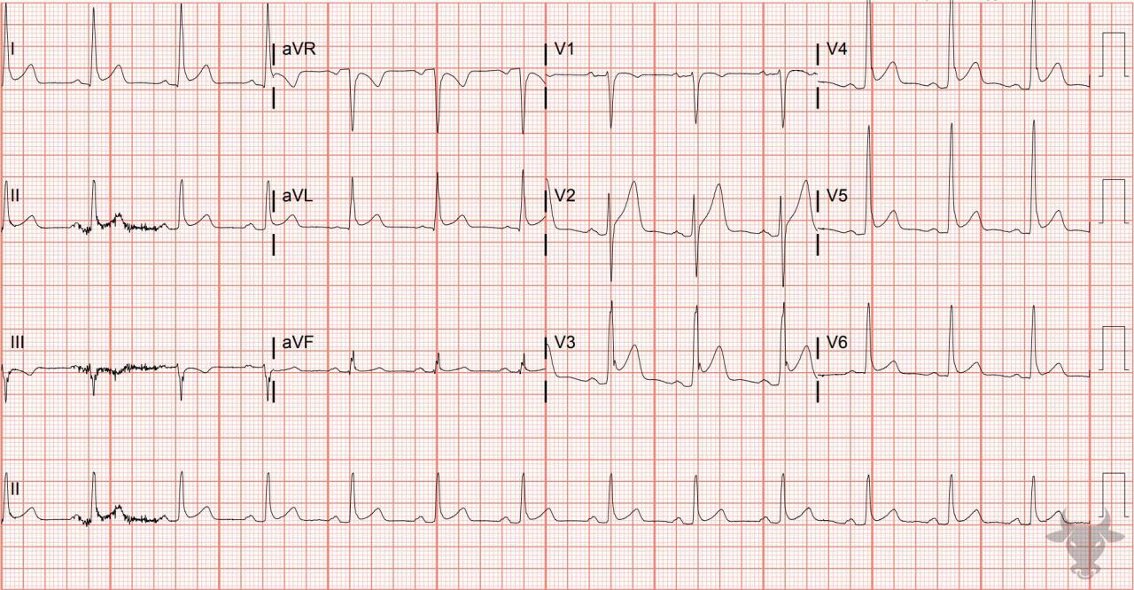 Early Repolarization | ECG Stampede
