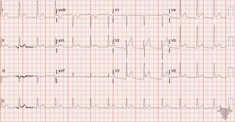 Early Repolarization | ECG Stampede