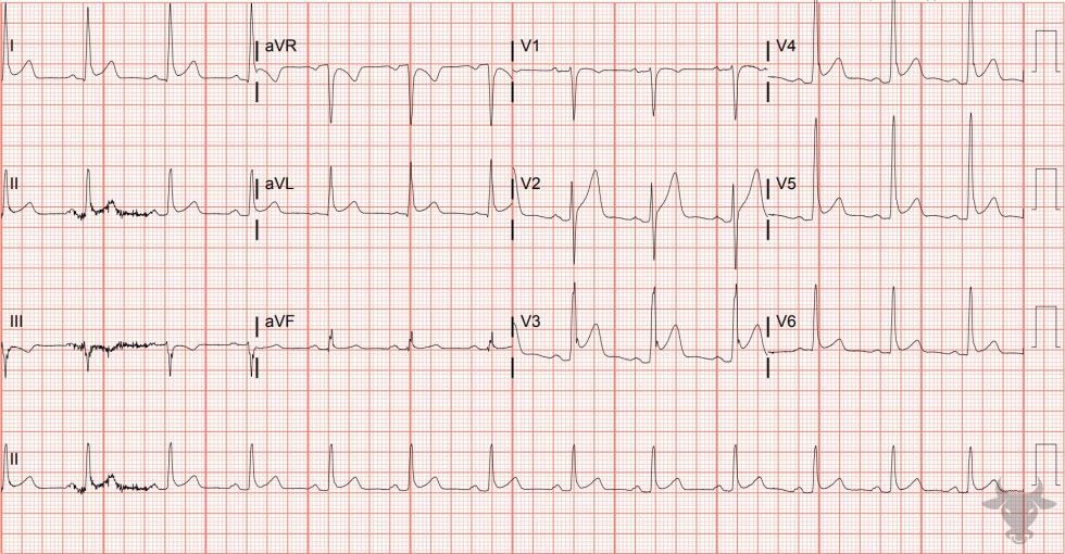 Early Repolarization | ECG Stampede